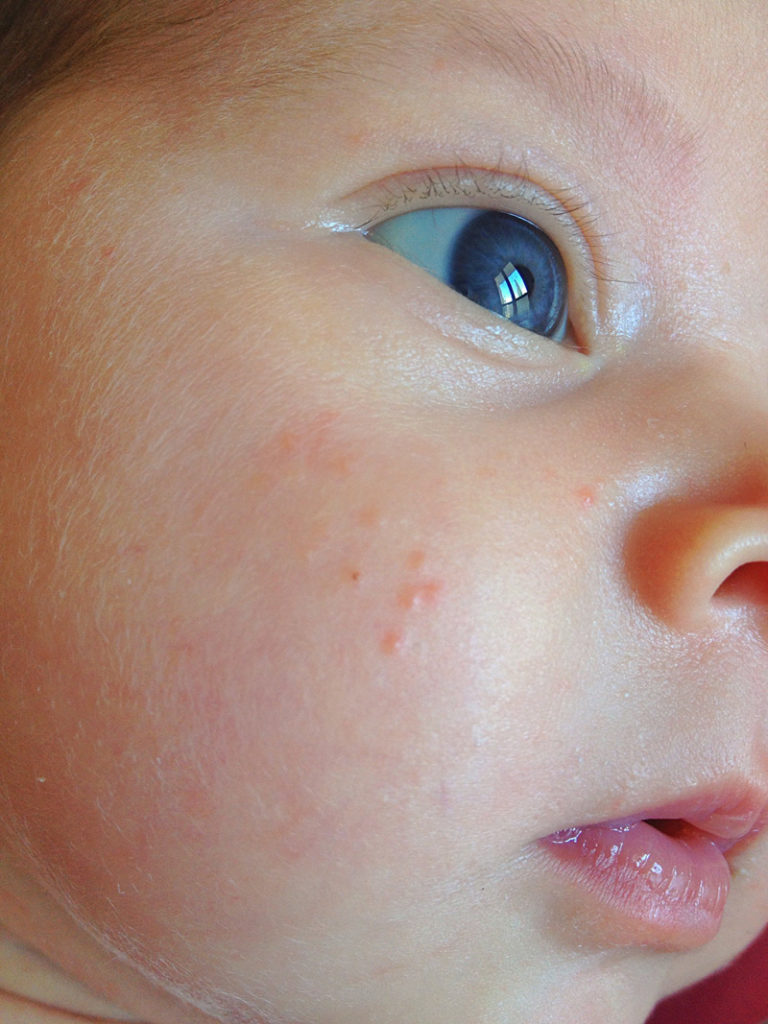 Is Your Newborn’s Appearance Normal? – Lisa Lewis, MD